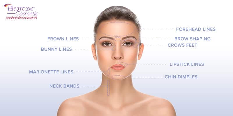 Botox: The Safe Neurotoxin for Youthful Skin | All About Aesthetics