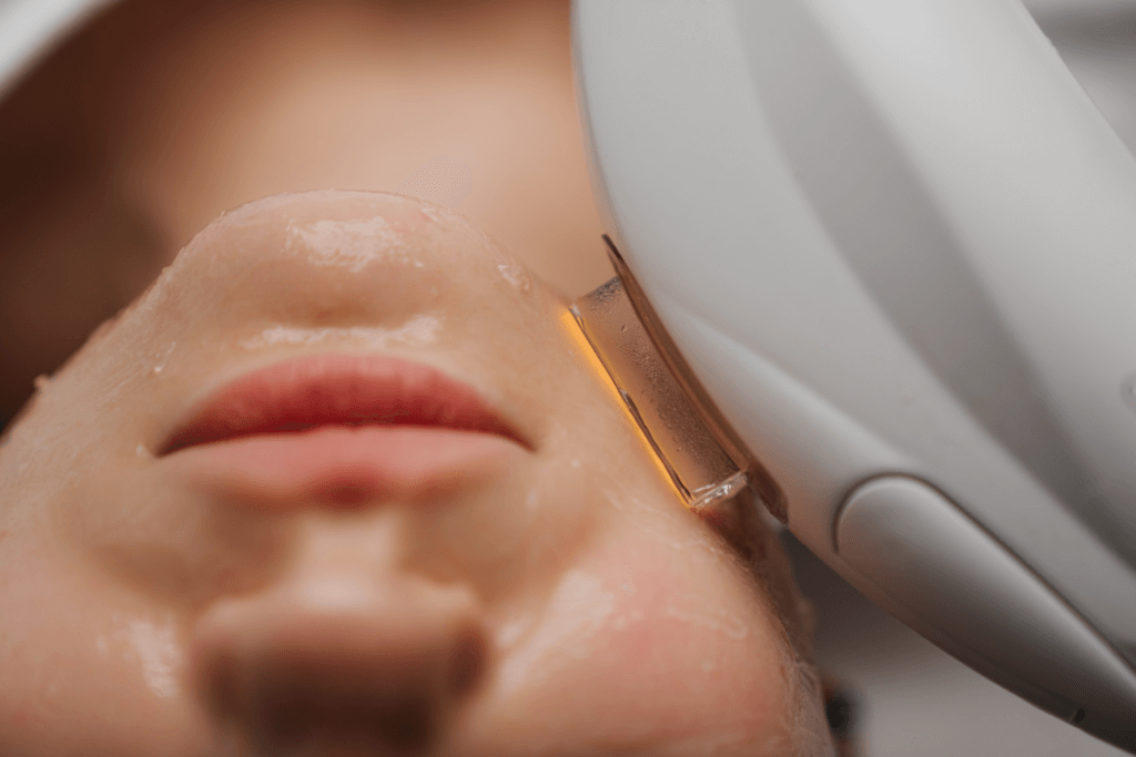 Lumecca Intense Pulse Light - All About Aesthetics